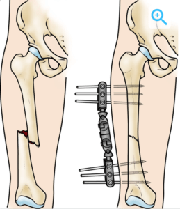 Open Reduction and Closed Reduction Internal Fixation: Pros and Cons ...