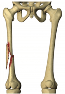 Open Reduction and Closed Reduction Internal Fixation: Pros and Cons ...
